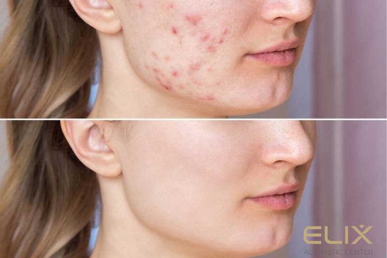 Acne treatment in Armenia