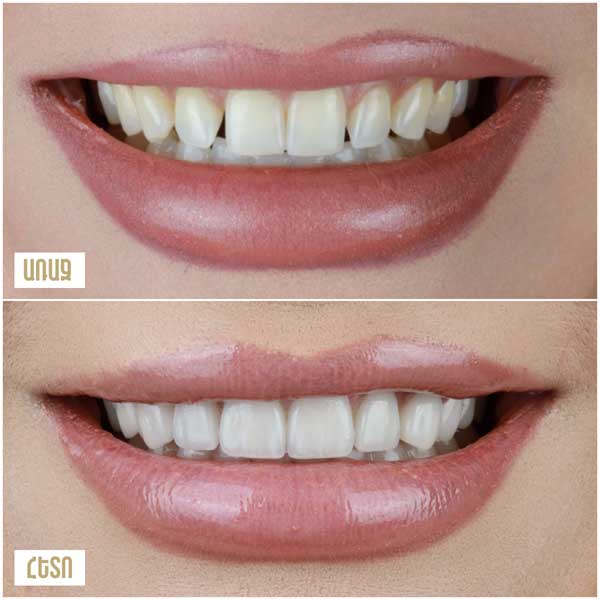 Ceramic veneers at the best price in Yerevan